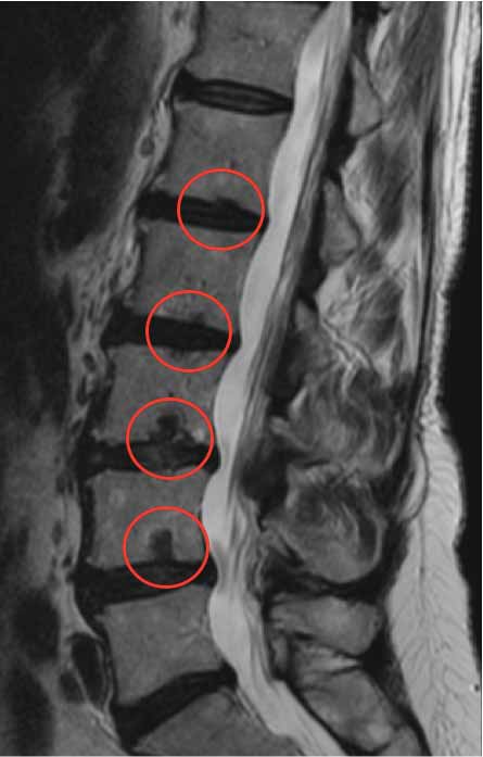 O que é Nódulo de Schmorl - Dr. Luciano Pellegrino - Ortopedista
