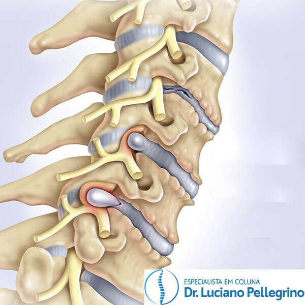 Problemas De Coluna Cervical | Unidade da Coluna Vertebral – FMQZXS
