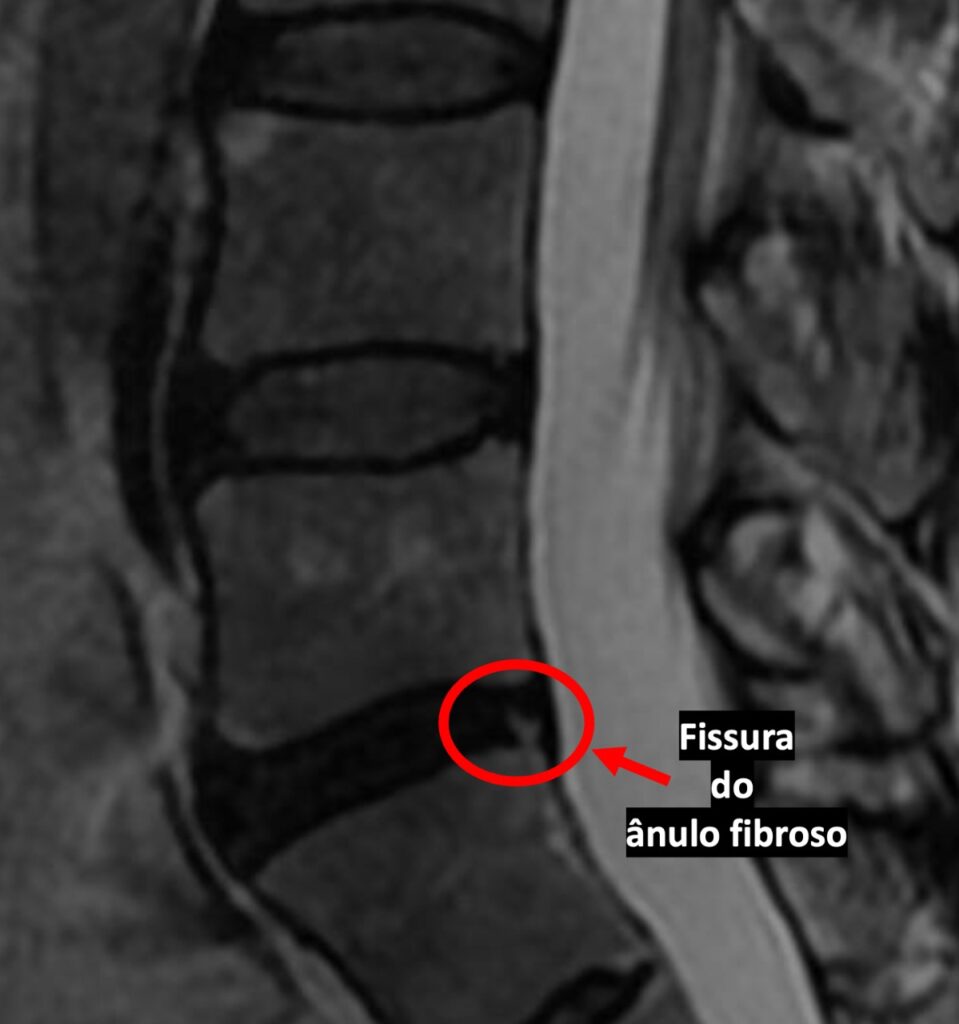 Fissura do Ânulo Fibroso - Devo me preocupar?
