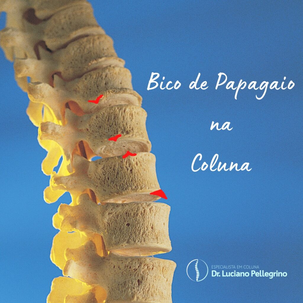 Bico de Papagaio na Coluna (Osteófito) - Dr. Luciano Pellegrino