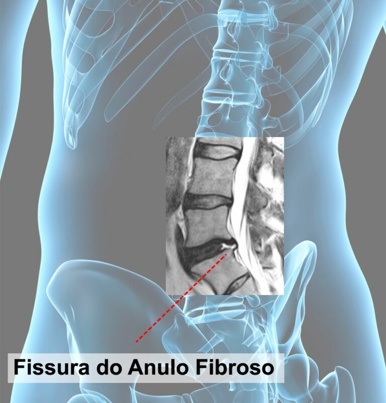 Fissura do Ânulo Fibroso - Devo me preocupar?
