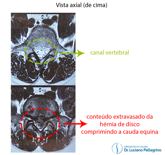 Síndrome da Cauda Equina - Um Caso de Emergência