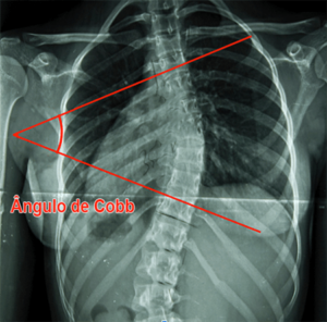Escoliose Idiopática - Qual o melhor tratamento?